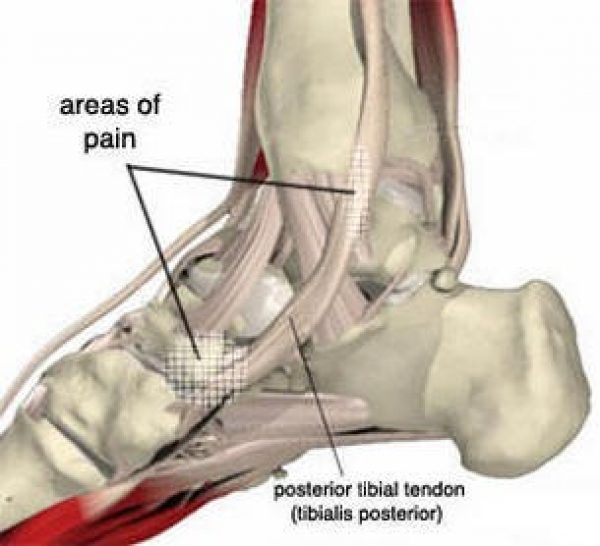 Tibialis Posterior Dysfunction - Erica Dash Podiatry