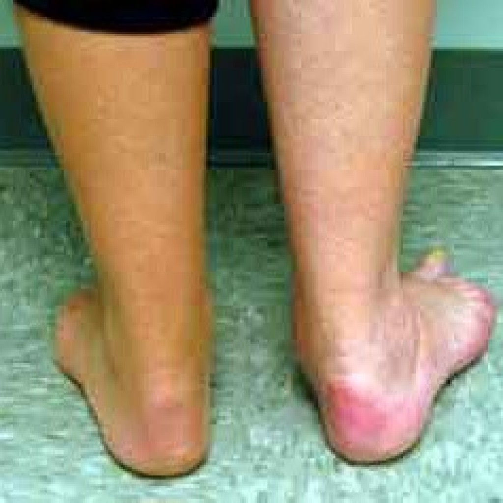Tibialis Posterior Dysfunction - Erica Dash Podiatry